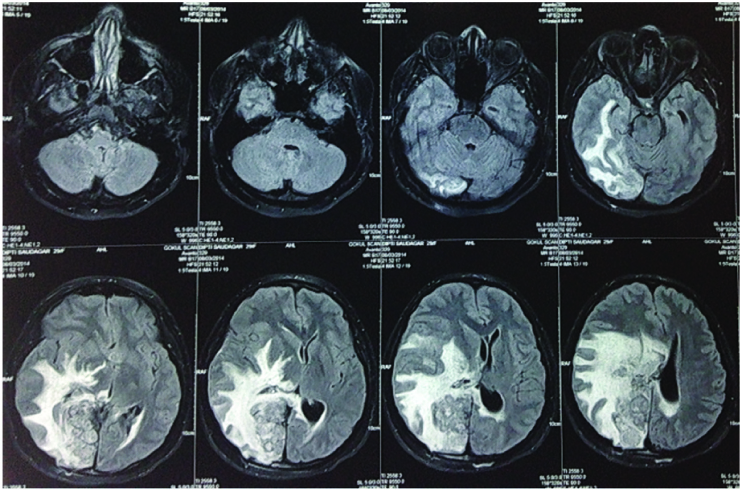 MRI image showing intracranial SOL at the site of AVM with atypical ...