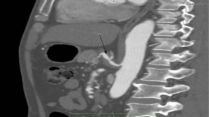 Dissection Celiac Artery