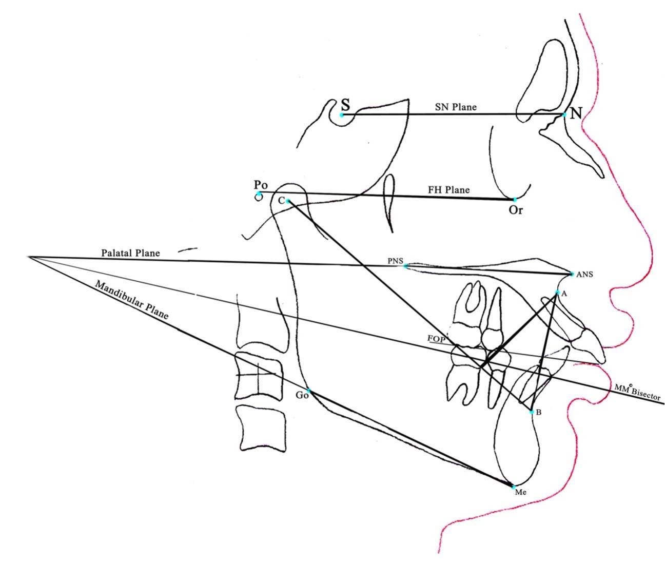Sella-Nasion (SN) plane: The line connecting S and N.