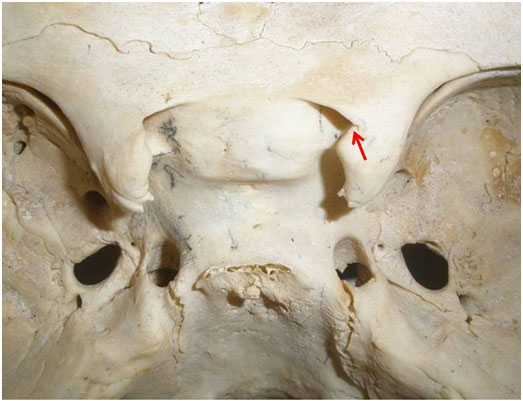 Shows presence of recess and fissure on right cranial opening of optic ...