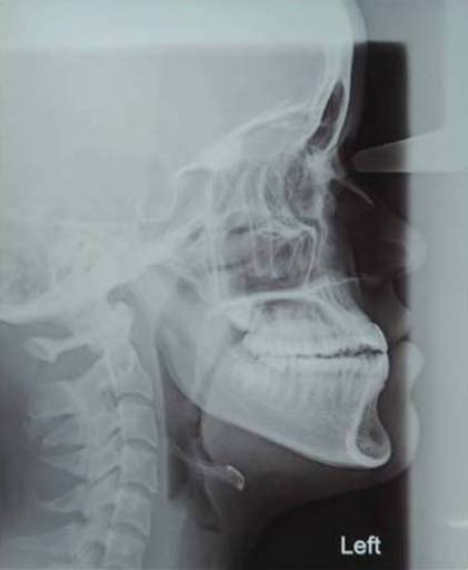 Pre-treatment lateral cephalogram.
