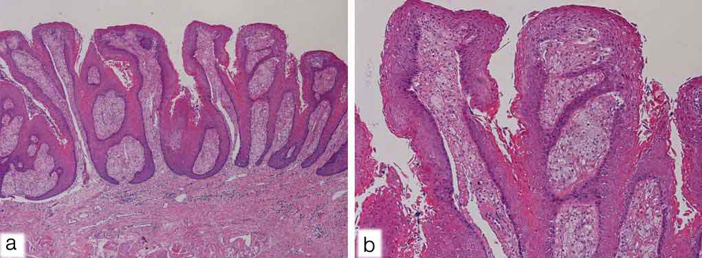 Verruciform Xanthoma Histology