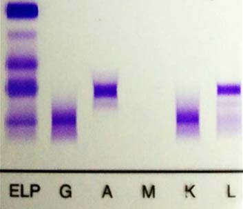 Serum immunofixation electrophoresis.