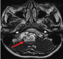 CT scan demonstrated the lesion entering the right hypoglossal canal ...