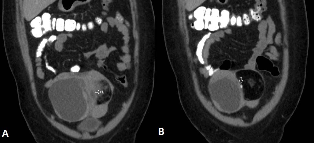 Coronal re-constructions of the CECT of the same patient show the ...