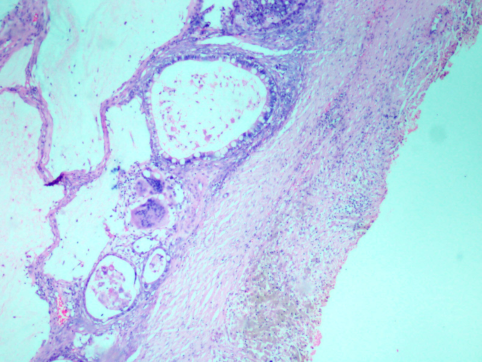 Presence of mucin pools with admixed goblet cells and accompanying ...