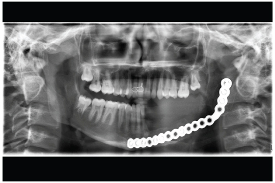 Swing Lock Denture