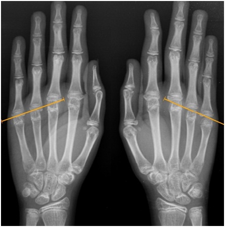 Patient was counseled and was put on Estrogen therapy for the ...