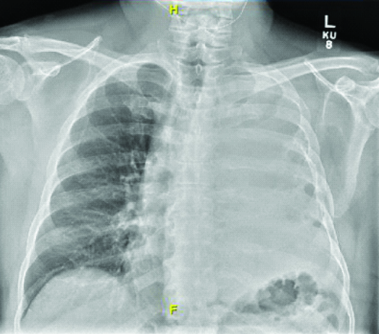Portable chest X-ray done on admission in emergency room showing ...