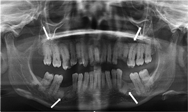Gigantiform Cementoma Jcdr 11 ZD21 G001.jpg