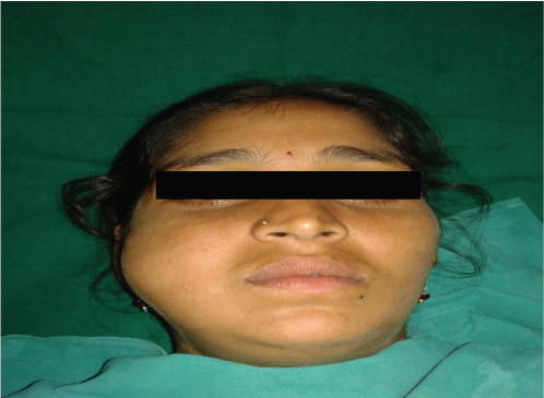 Diffuse swelling in the middle third of the face.