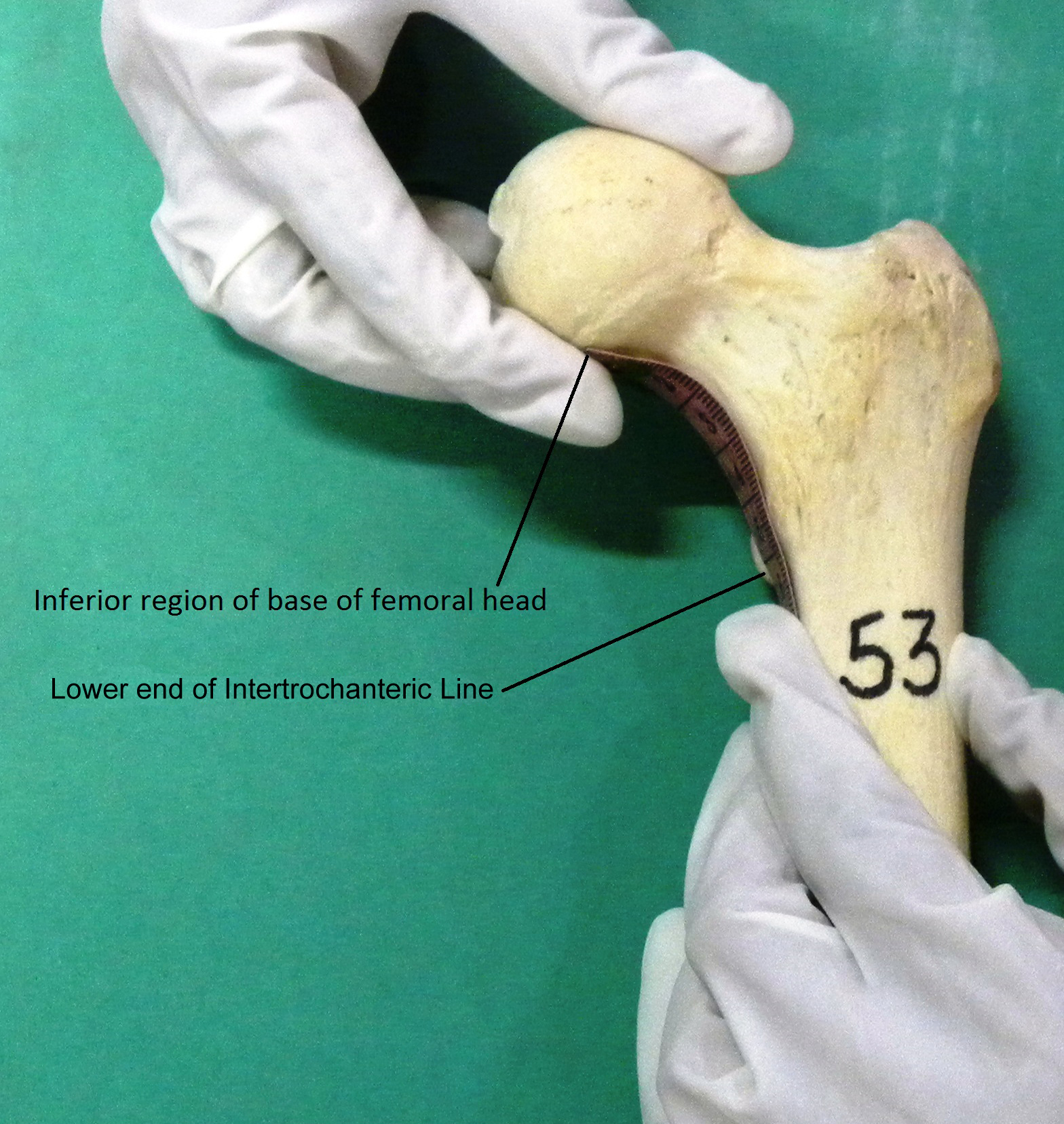Intertrochanteric Line Of Femur Intertrochanteric Fractures