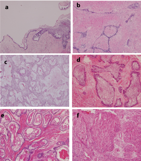 Plexiform Ameloblastoma Histology