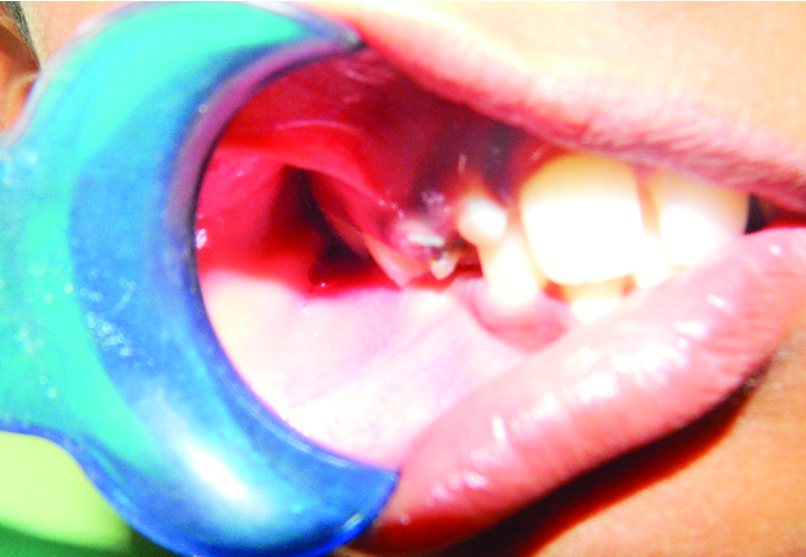 Showing decreased vertical dimension of occlusion with the upper right ...