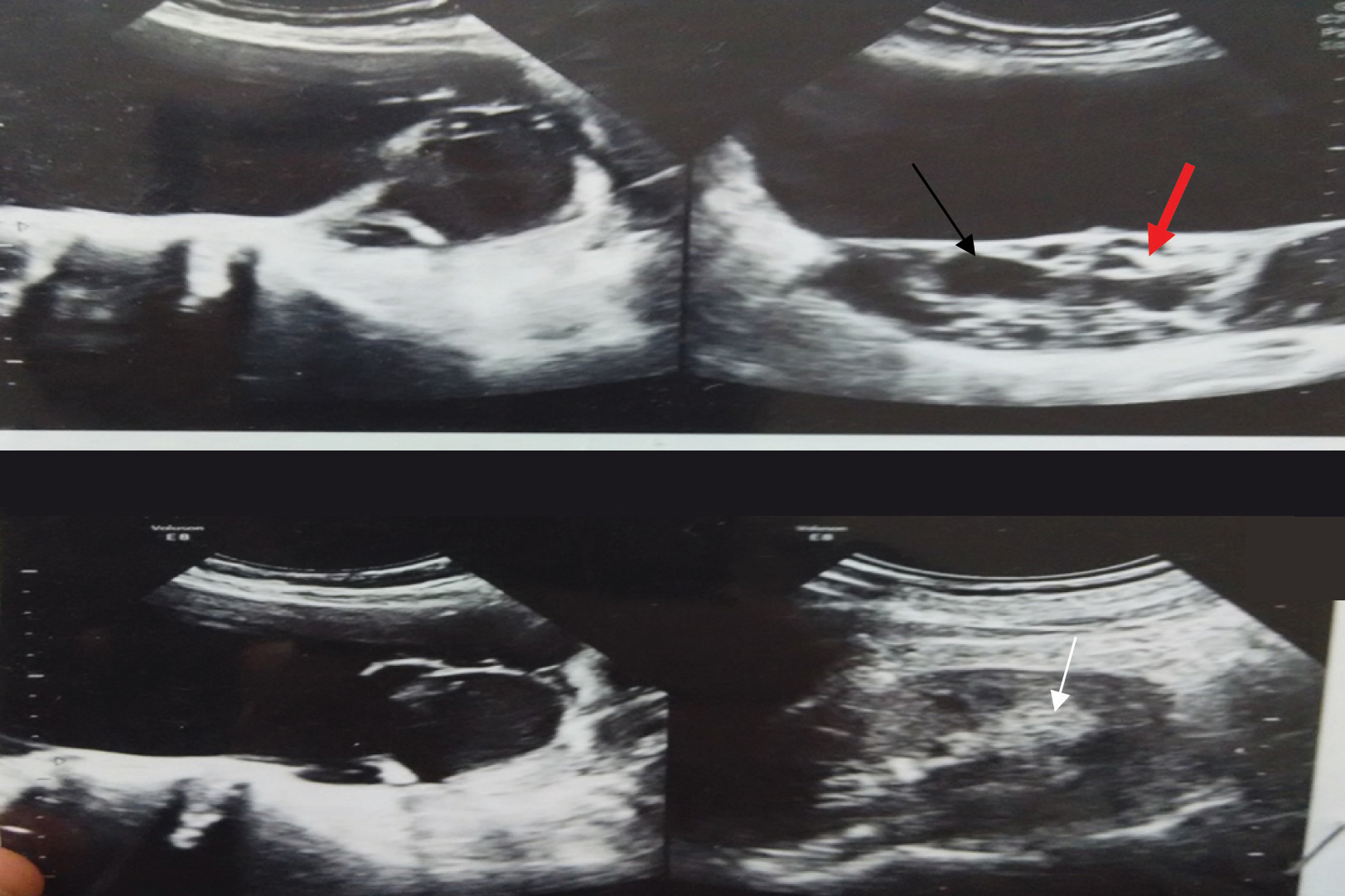 Grayscale transabdominal ultrasonographic picture showing ...
