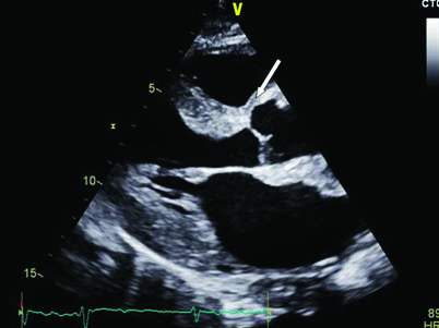 In view of infiltrative changes of myocardium and macroglossia a ...