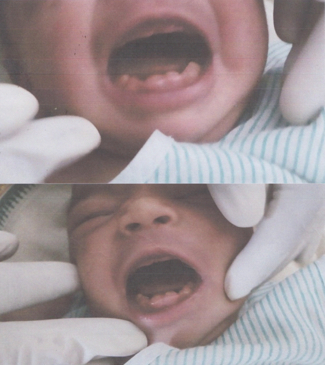 Neonatal Teeth
