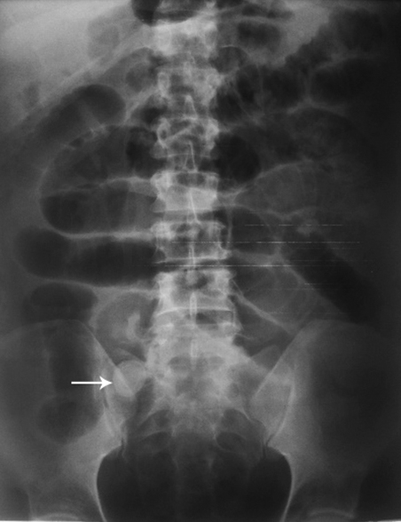 Meckel Diverticulum Xray