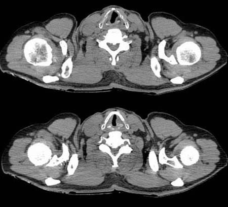 Neck CT at the level of the larynx showing anteromedial deviation of ...