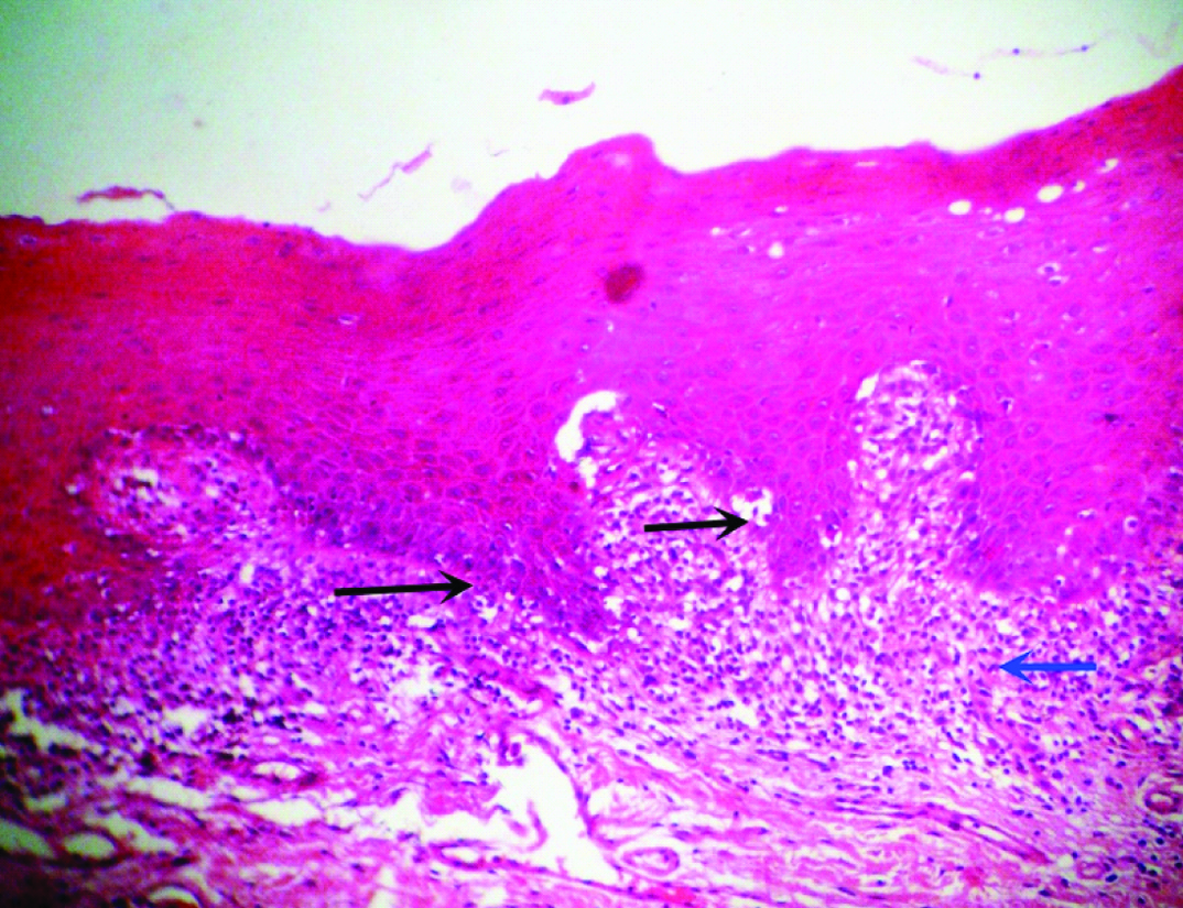 Lichen Planus Histology Sawtooth