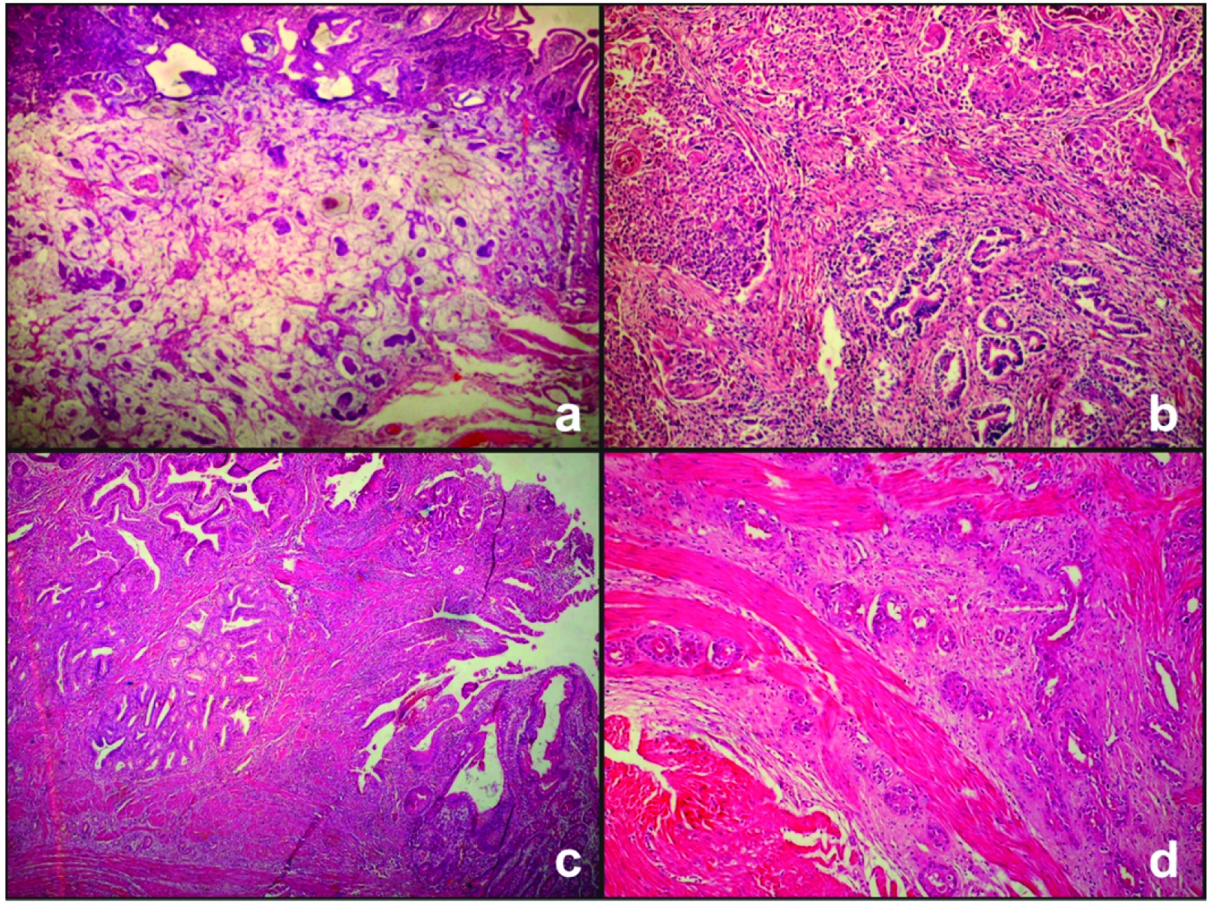 Ampulla Of Vater Histology