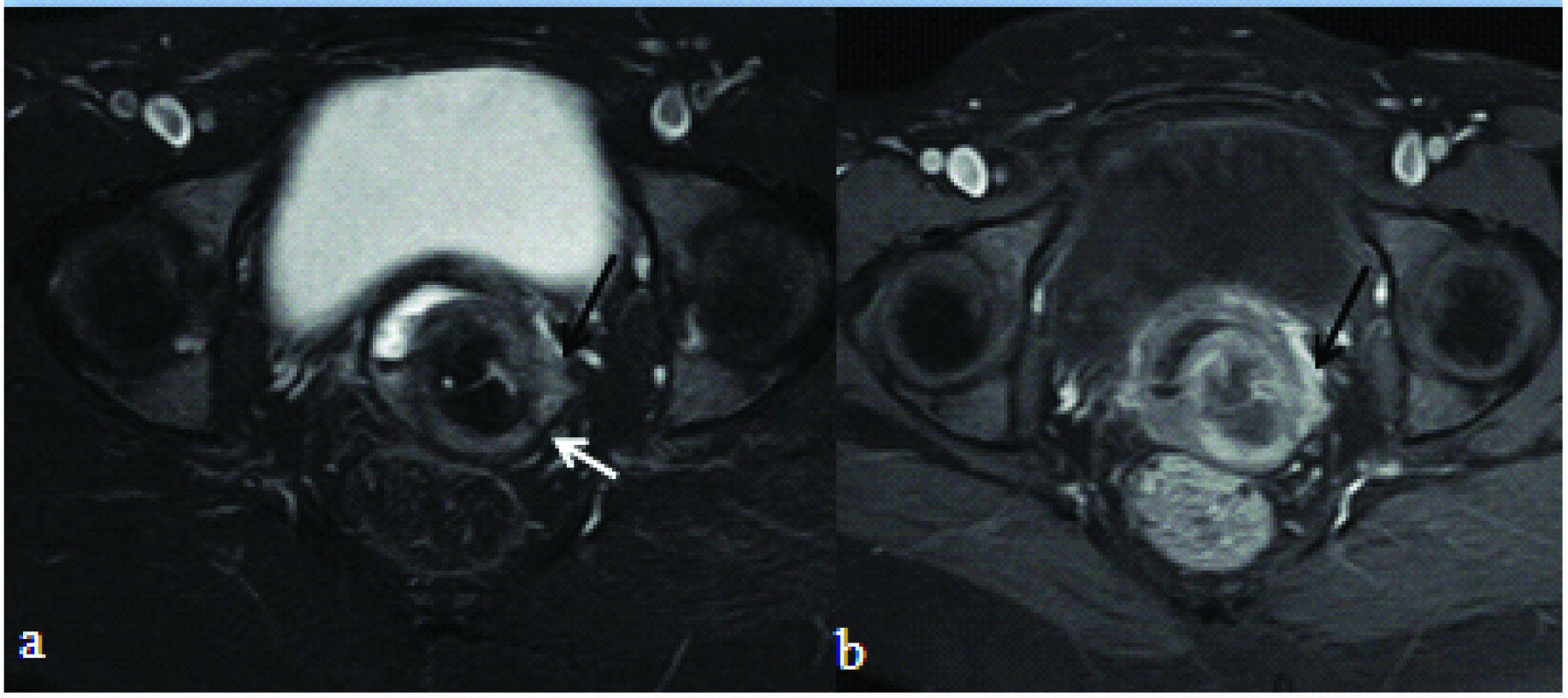 T2 weighted axial: a) and T1 fat suppressed post contrast axial image ...