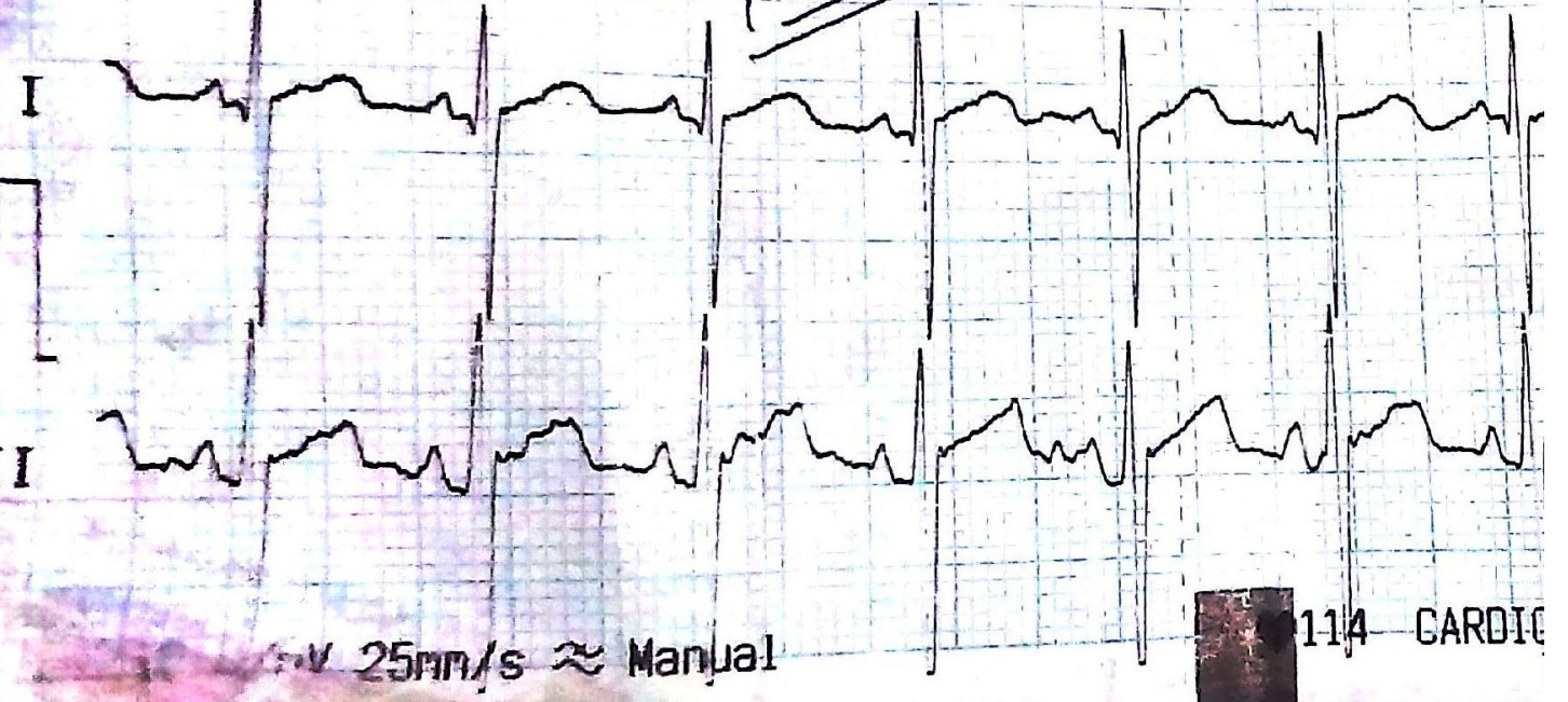 ECG showing characteristic short PR interval and large QRS complex as ...