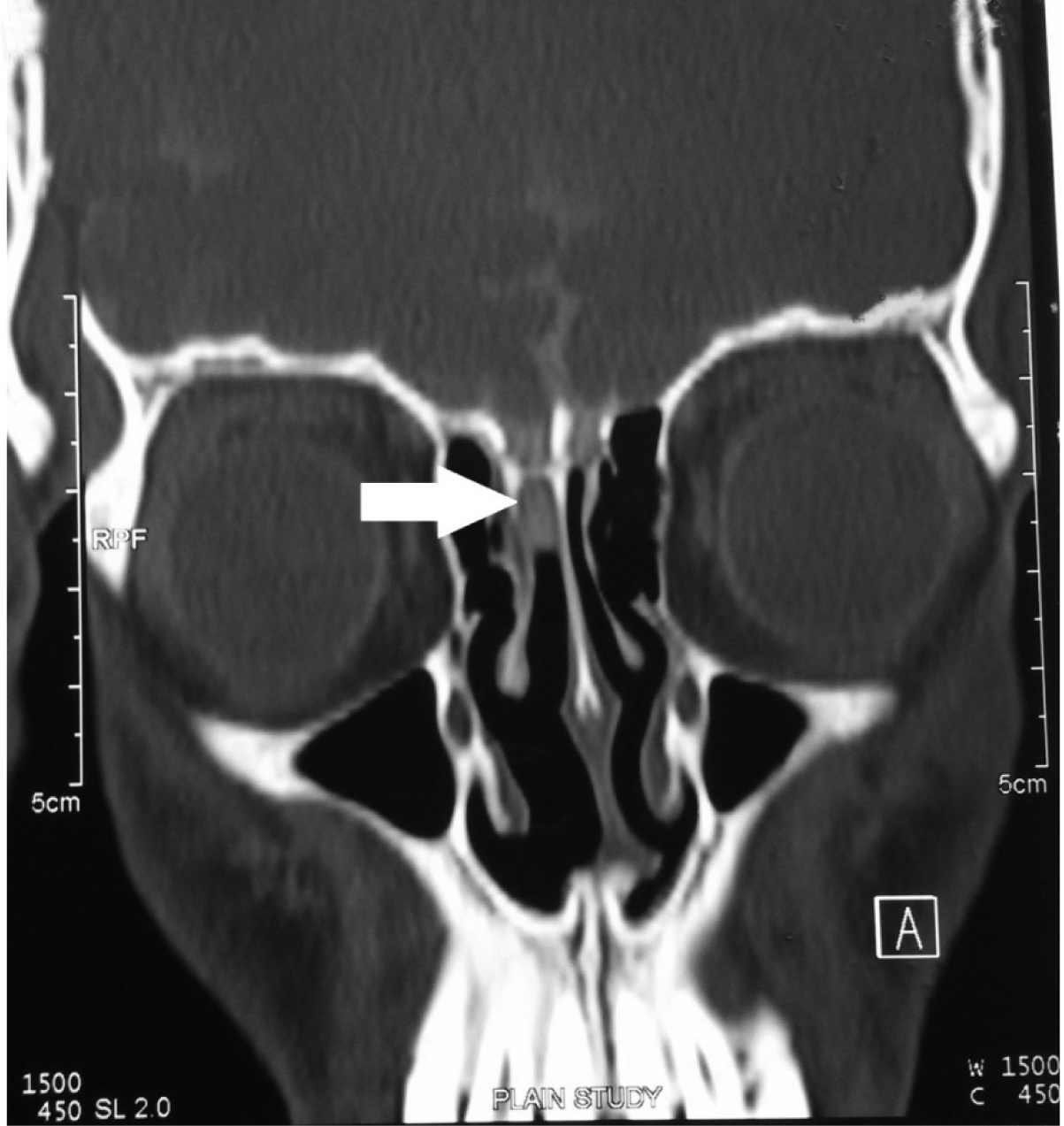 A planned surgical repair of the defect was done through intranasal ...