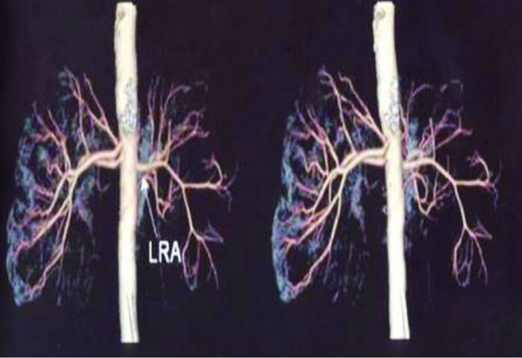 Right Inferior Renal Pole